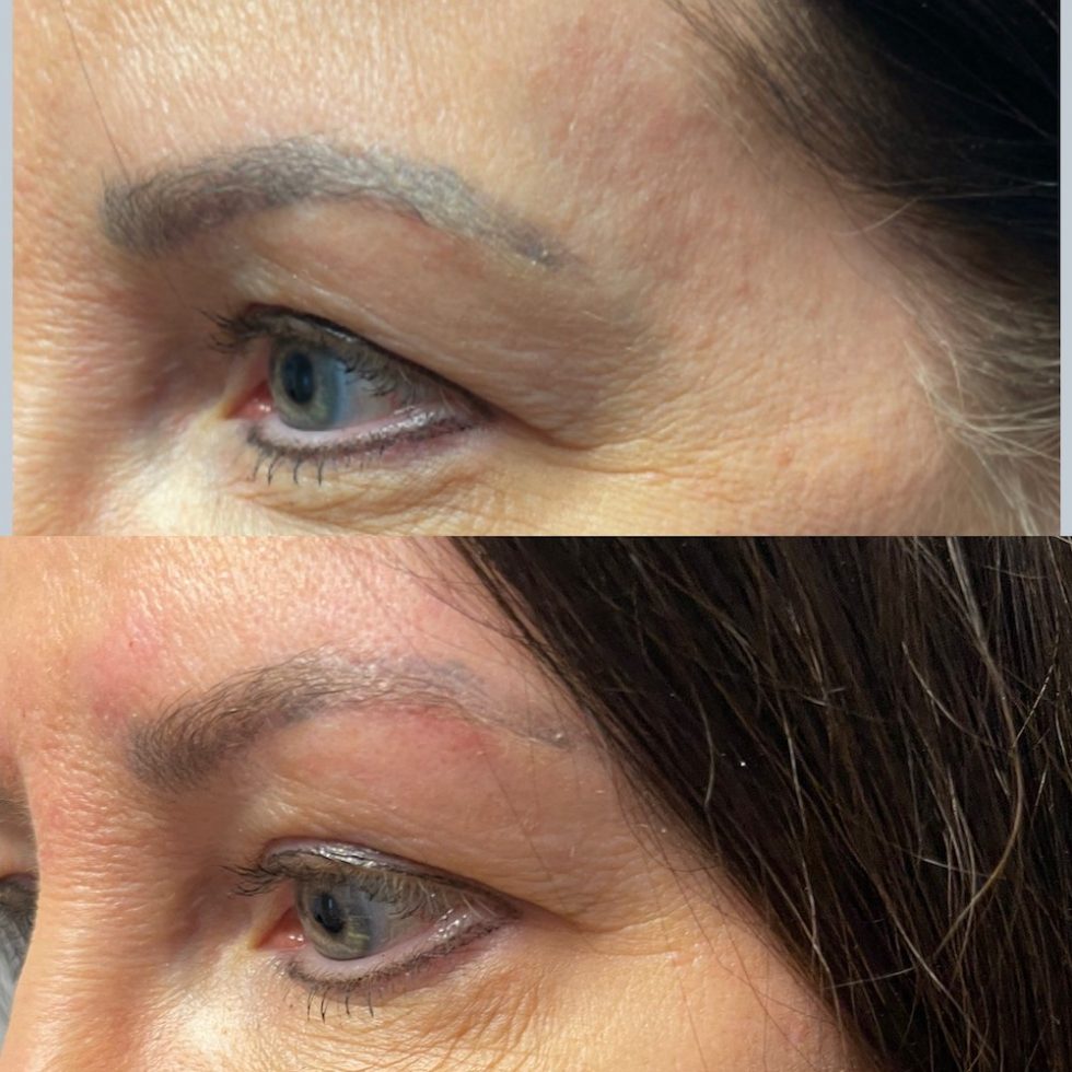 Cosmetic Thread Lifts - Glam + Glo Medical Aesthetics Lounge